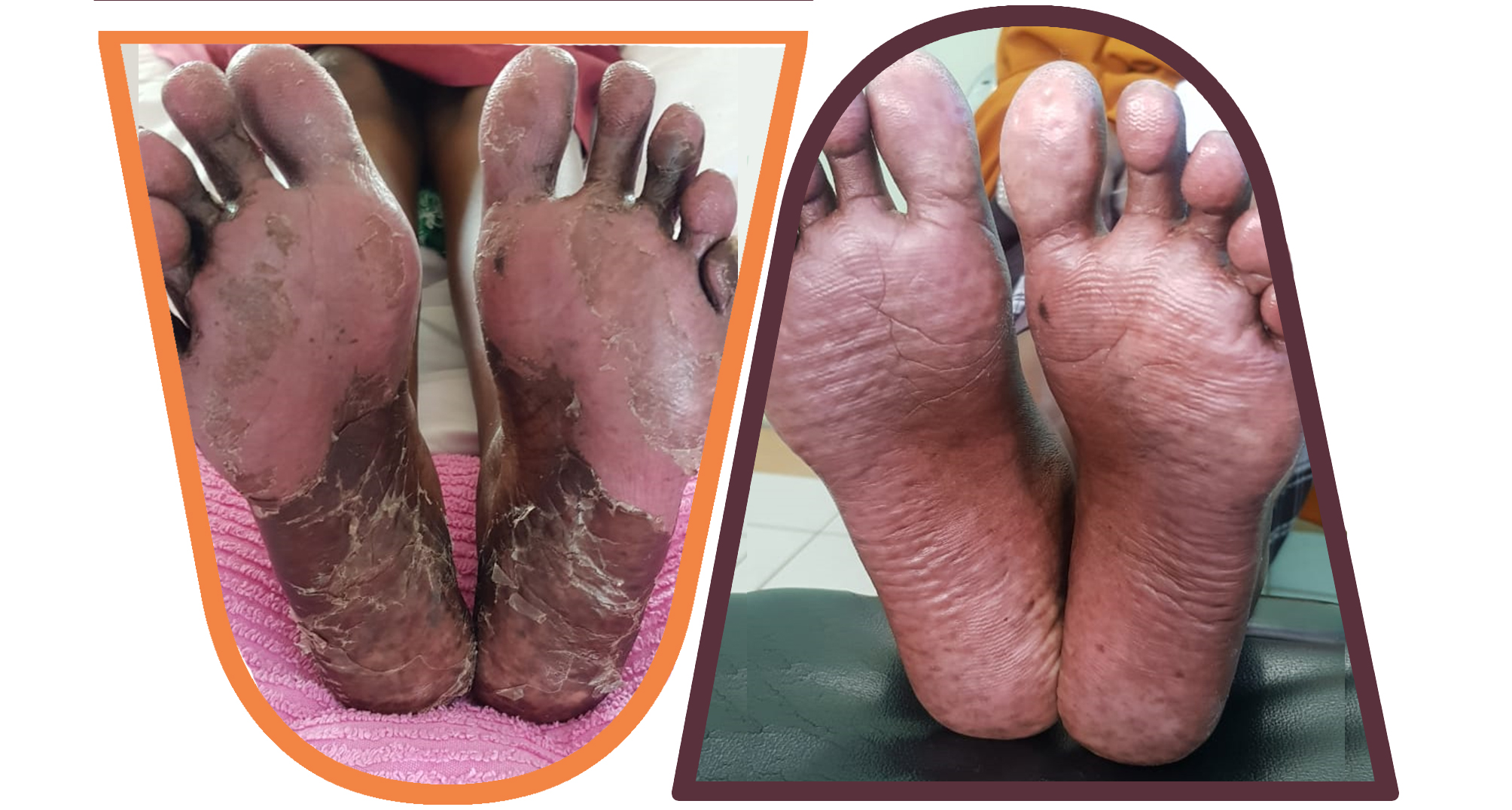 Chemofoot | Prospectia Overseas Consulting SL | CPHI Online